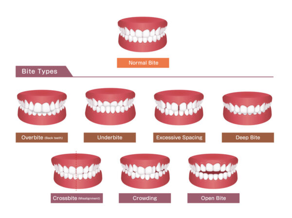 Understanding the Importance of a Normal Bite - Dr. Randall K. McVey ...